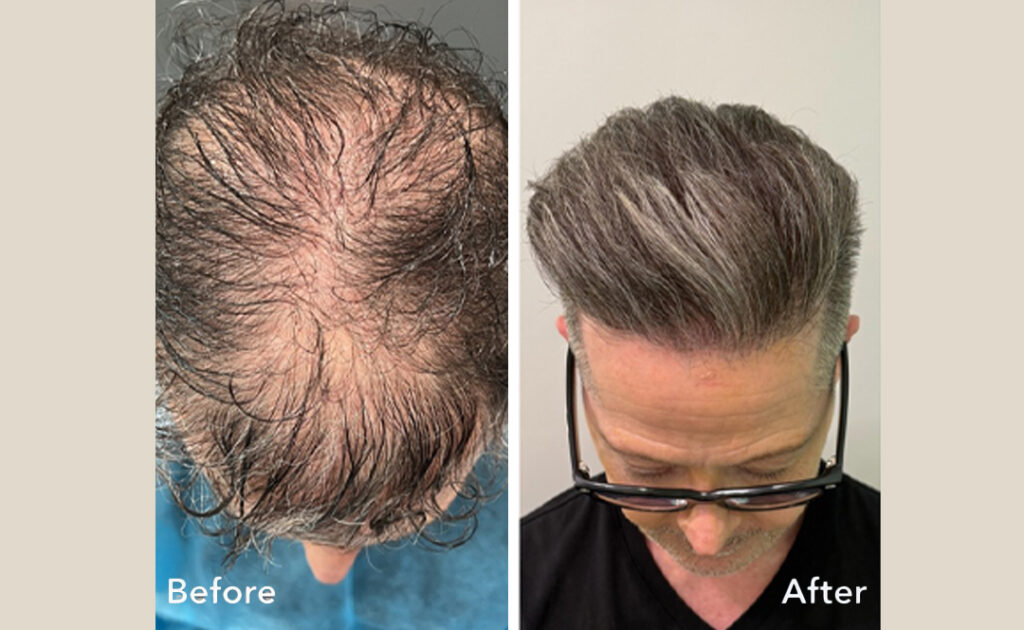 Hair Restoration in Studio City | BeauTech Cosmetic